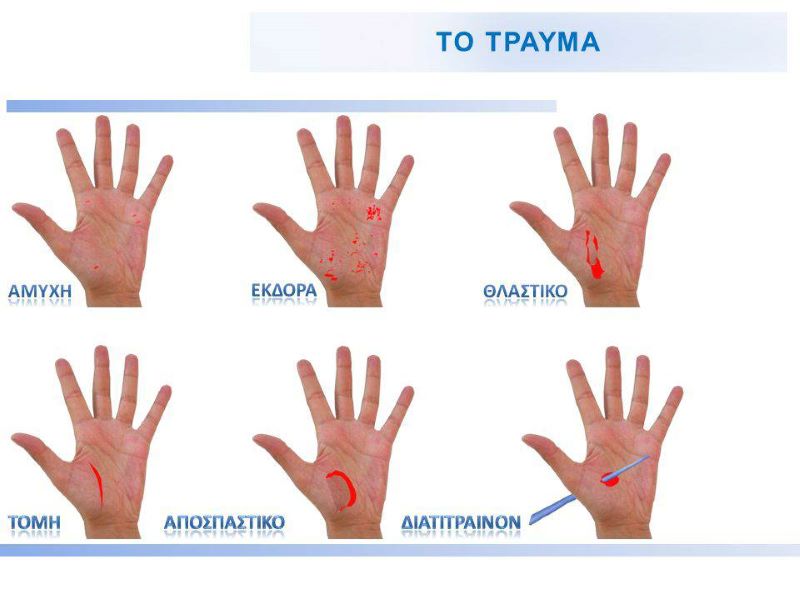 Τραύματα: Οι πρώτες βοήθειες που πρέπει να γνωρίζουμε - trikalaIN